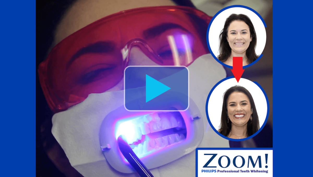 Do Your Teeth Continue to Whiten After Treatment? - Lane & Associates