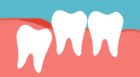 6 Possible Signs of Wisdom Teeth Coming In - Lane & Associates
