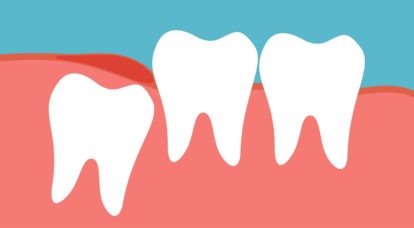 6 Possible Signs of Wisdom Teeth Coming In - Lane & Associates