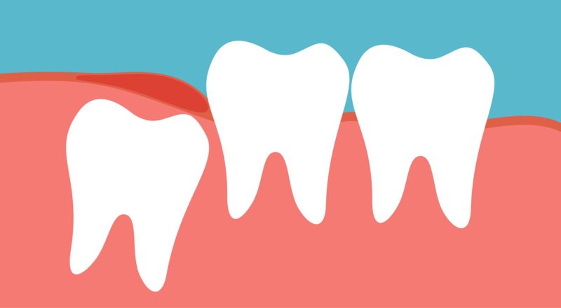 6 Possible Signs of Wisdom Teeth Coming In - Lane & Associates