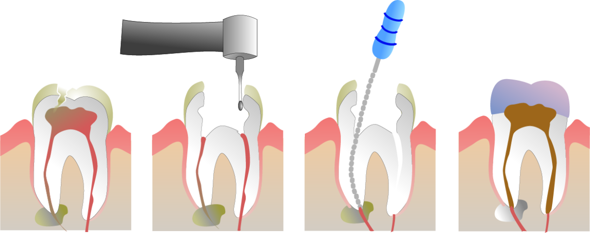 Endodontics at Lane & Associates Family Dentistry - Lane & Associates