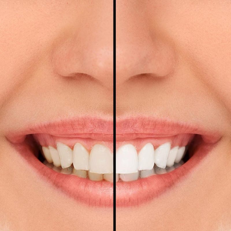 Can Toothpaste Whiten Teeth? - Lane & Associates