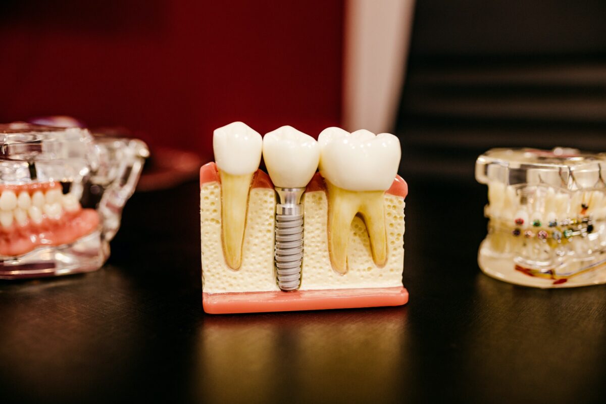 Can a Dental Bridge be Replaced? - Lane & Associates